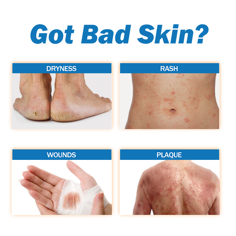 Buy Skin Irritation Ointment & Lotion for Itchy Skin | Lauricidin